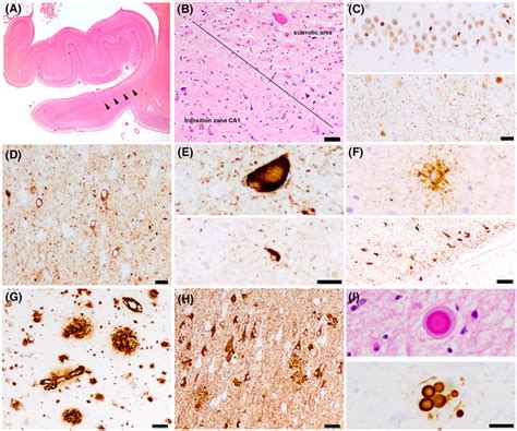 Frequent Co‐pathologies In Als A C Segmental Hippocampal Sclerosis