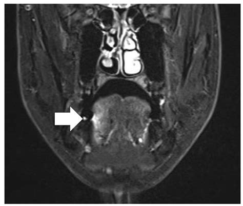 Contrast Enhanced Mri T1 Weighted Image A Contrast Enhanced Mri