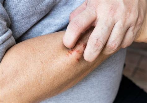 Adaptic Vs Xeroform Must Know Guide For Smart Dressing