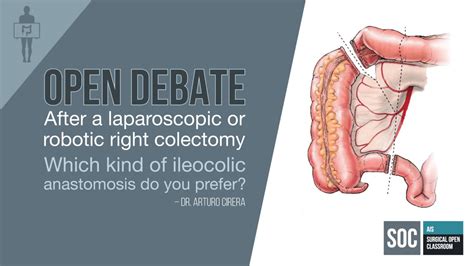 Incontinence After A Colectomy At Charles Rolle Blog