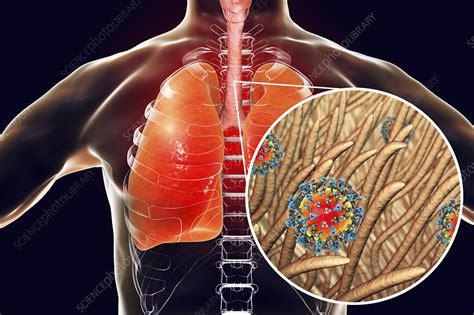 Pneumonia Caused By Measles Viruses Conceptual Illustration Stock