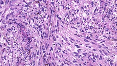 Jerad Gardner Md Liver Tumors W Desmoplasia 1 Fibrolamellar Hepatocellular Carcinoma Shown