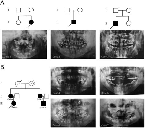 oral phenotypes of ccd individuals a pedigree of three unrelated