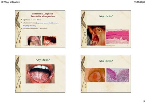 Differential Diagnosis For Oral White Lesions Ppt