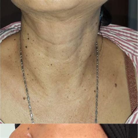 Clinical Presentation At Diagnosis A Growing Lump In The Mandible