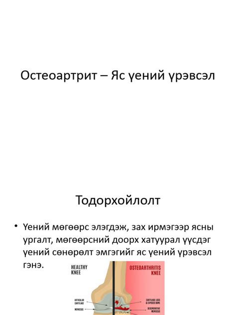 Остеоартрит Pdf