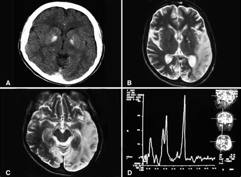 A Computed Tomography Brain Scan Showing Bilateral Basal Ganglia