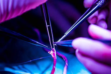 Coronary Bypass Grafts Fail More Frequently In Women Than In Men