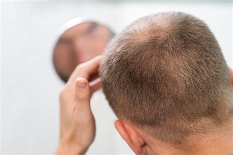 Hair Lossalopecia Areata With Etiology And Remedy