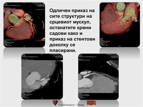 Ppt 64 СЛОЈНА КОМПЈУТЕРИЗИРАНА ТОМОГРАФ Ija НА КОРОНАРНИ КРВНИ САДОВИ Kt КОРОНАРОГРАФИЈА