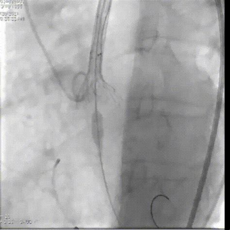 嘉境 · 瓣旅｜四川大学华西医院陈茂团队成功完成tauruselite®可回收经导管主动脉瓣系统上市后首次植入！ 严道医声网
