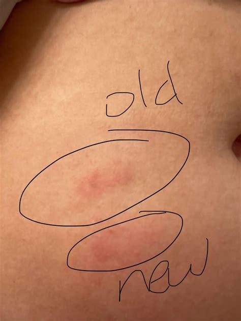 Injection Site Rash R Semaglutide