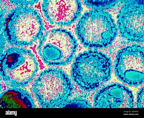 Herpes Simplex Viruses Coloured Transmission Electron Micrograph Tem
