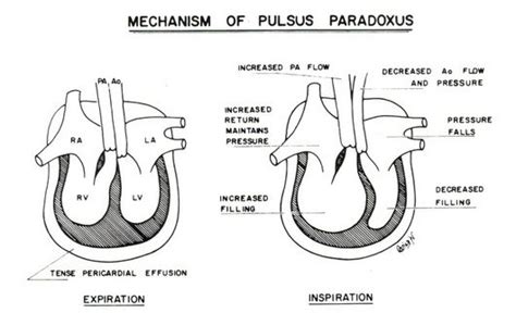 Pulsus Paradoxus Clinical Examination Epomedicine