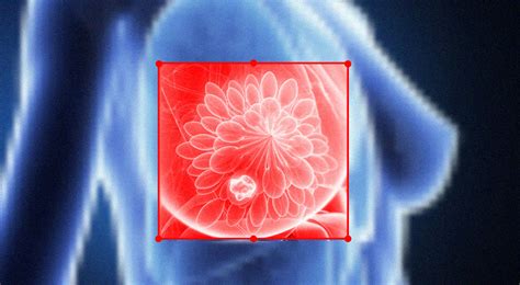 Ai Sharpens Breast Cancer Detection Cybernews