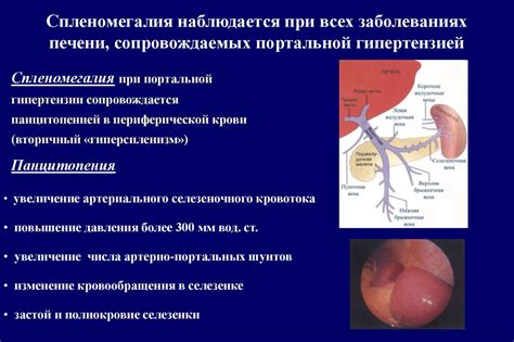 Синдром портальной гипертензии презентация онлайн