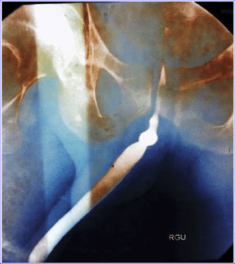 Retrograde Urethrogram Of A 40 Year Old Man Showing Short Segment