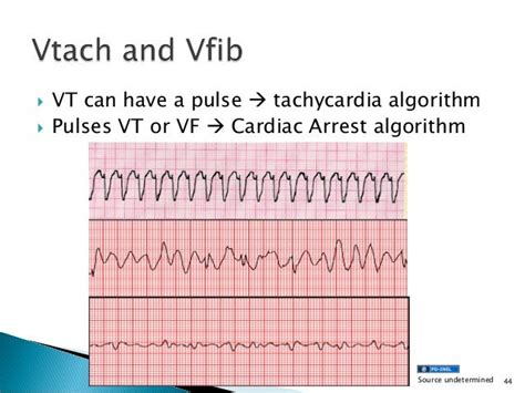 Gemc Ekg And Rhythm Interpretation 101 For Residents
