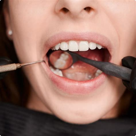 Fissure Sealants Mickleham Dental