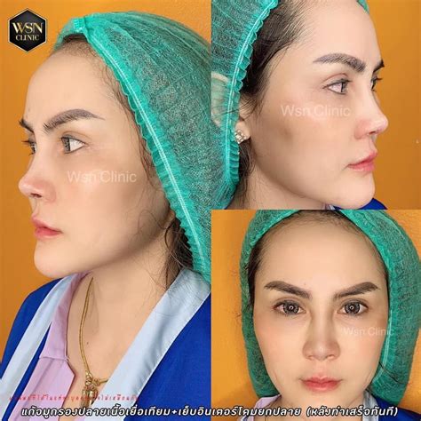 งานแก้จมูก ทรงสวย หน้าดูหวานขึ้น สโลปปลายพุ่ง 💕💕 สวยถูกใจ ลูกค้า Happy 😊😊 แก้จมูกรองปลาย