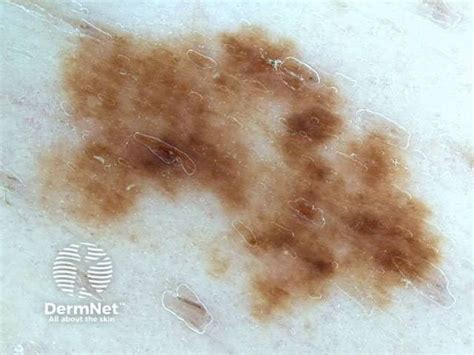 Dermoscopy Atypical Naevi