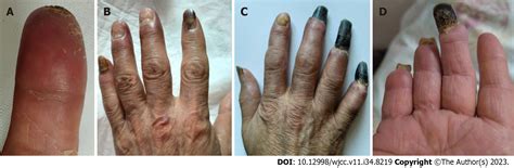 Fingers Peeling After Frostbite At Seth Darcy Irvine Blog