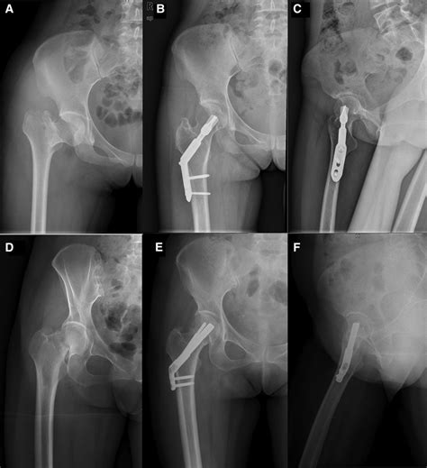 Frontiers Comparison Of Femoral Neck System Vs Dynamic Hip System