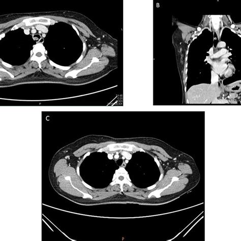 A And B Computerized Tomography Chest Scan Demonstrating A 08 Cm