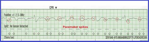 Code Blue Sudden Cardiac Arrest