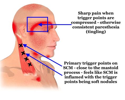 Splenius Capitis Trigger Points Splenius Capitis Trigger Points