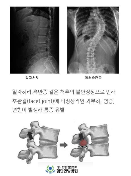 허리통증의 원인중하나 척추후관절증후군치료방법 광주 척추후관절증후군치료 광주 허리통증치료 네이버 블로그