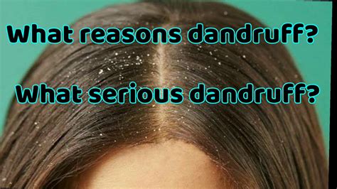 What Causes Dandruff And Why Happens And How To Treat