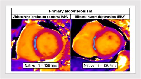 Figure 1 Regions Of Interests Forevaluation Of Native T1 And Ecv Were Placed On The Mid Wall Of
