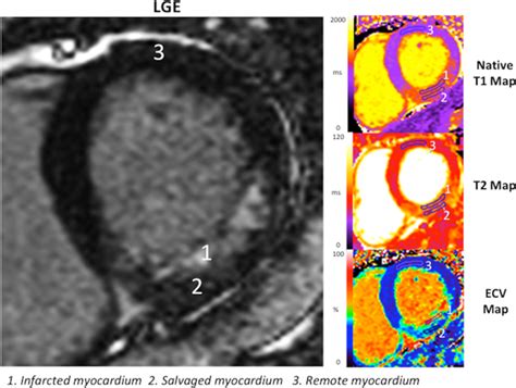 Interrogation Of The Infarcted And Salvaged Myocardium Using Multi Parametric Mapping
