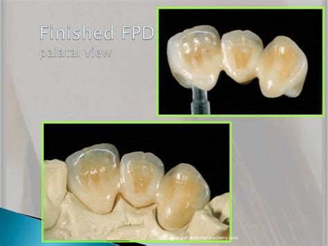 Porcelain And Its Applicationsnew Certified Fixed Orthodontic Courses…
