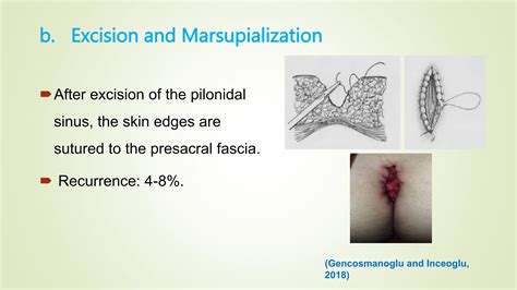 Pilonidal Sinuspptx