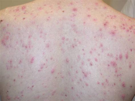 Acne Vulgaris Back