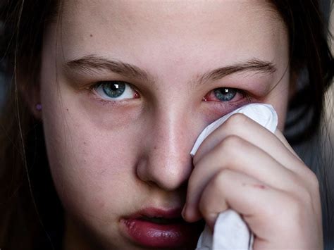 Can You Wear Eye Makeup If Have Conjunctivitis Saubhaya Makeup