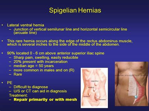 Occult Inguinal Hernia Symptoms Noticias Formosago