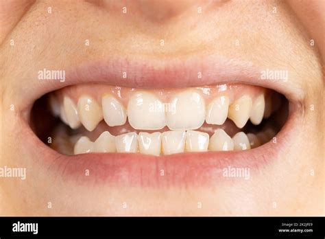 Patient With Malocclusion Gap Between Upper And Lower Teeth Close Up