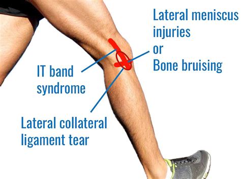 What Is Runner S Knee Called When It Is On The Lateral Side Of The Knee At Mike Fahey Blog