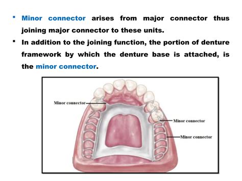 5 Minor Connectors Removable Partial Denture Ppt