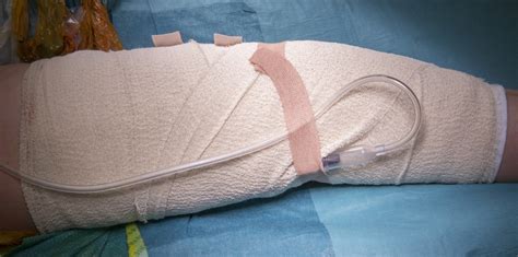 Distal Femoral Endoprosthesis Stanmore Juvenile Tumour System Custom