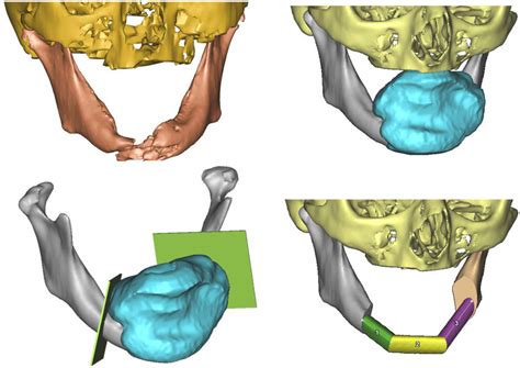 Planning Osteoradionecrosis Orn 3 Dimensional 3d Planning 3d
