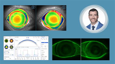 Case Reports Eaglet Eye