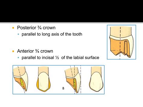 Principles Of Tooth Preparation In Fixed Partial Dentures Pptx