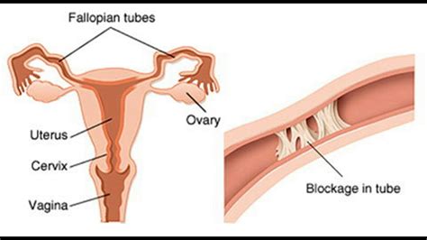 Blocked Fallopian Tubes Natural Treatment Youtube