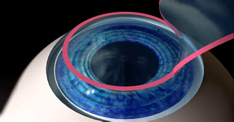 Cirugía Refractiva Con Excimer Láser Xr Oftalmología®