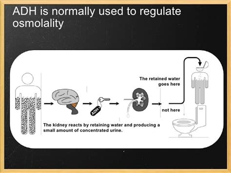 Hyponatremia