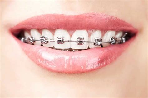 Dentadura Perfecta Cómo Lograr Una Sonrisa Impecable Ortodoncia Junin